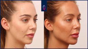 Jawline Unterspritzen - Behandlung & Kosten | AVESINA