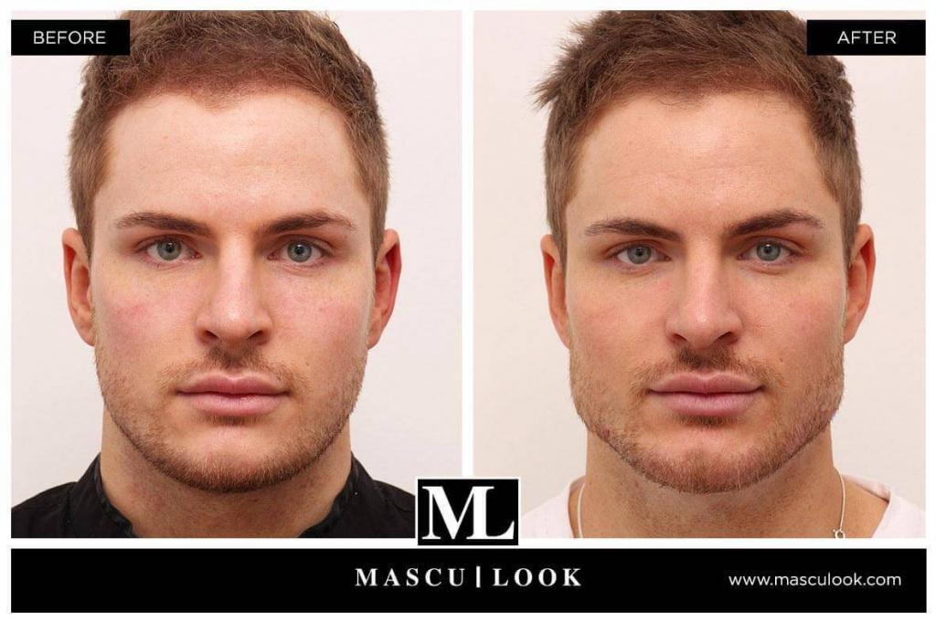 Jawline Behandlung für den modernen Mann bei Avesina