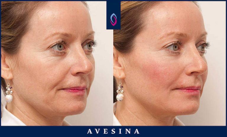 Behandlung von Hängebäckchen bei Avesina